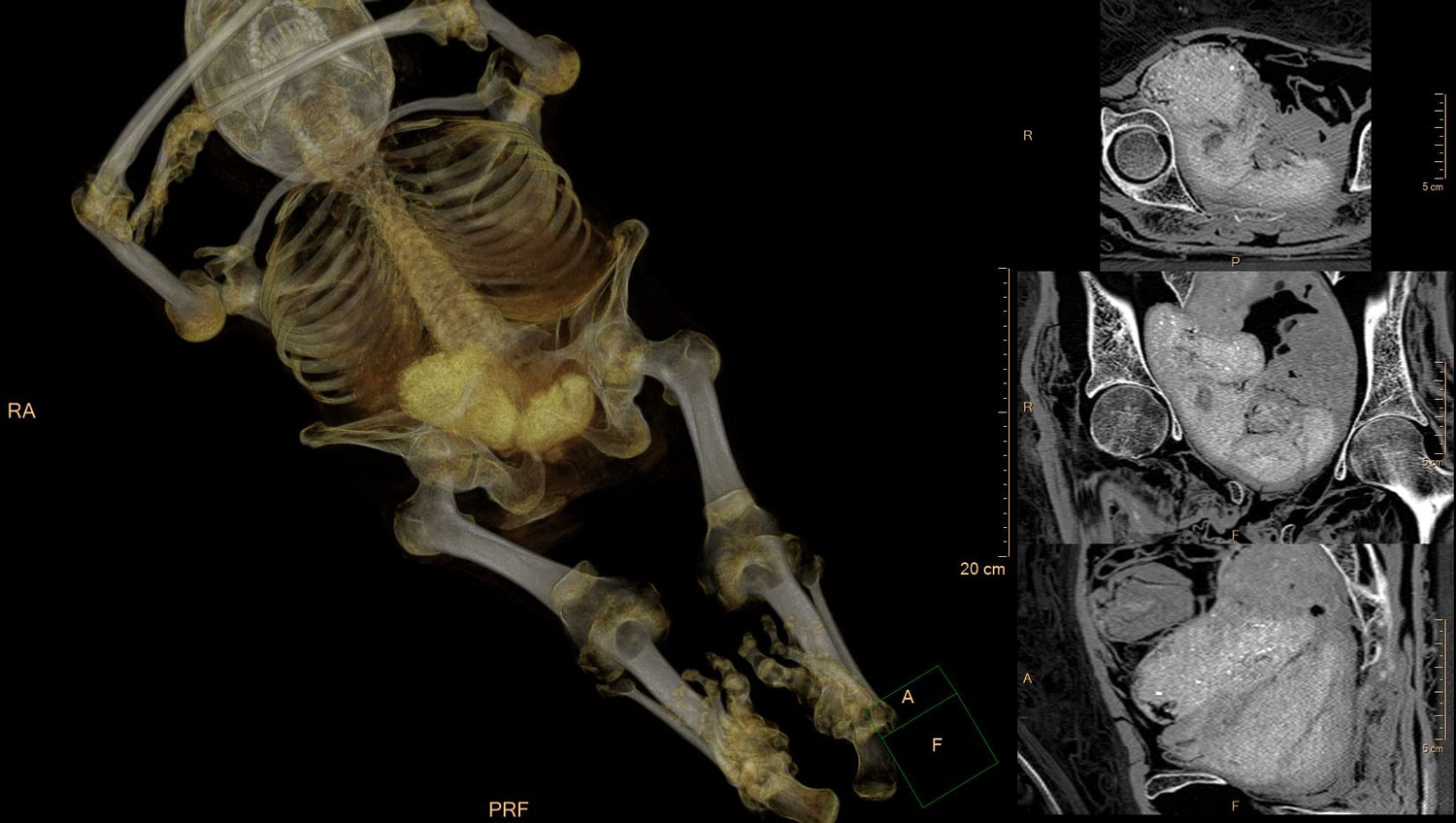 News - New Study Analyzes 'Pregnant' Egyptian Mummy - Archaeology Magazine